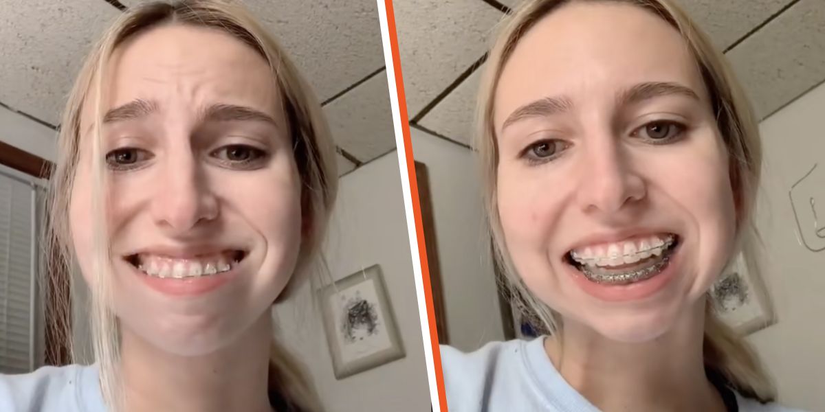 This Girl's Jaw Surgery Results Left People Speechless – Her Before-and ...