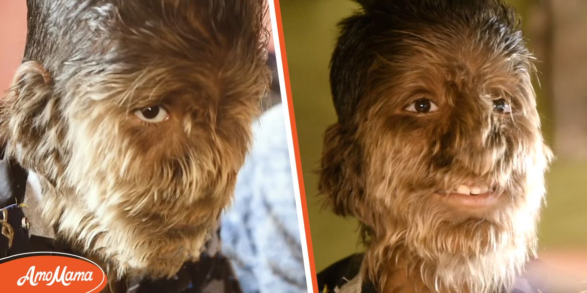 ‘Werewolf’ Boy Was Taunted by Kids & Thrown Stones at for His ...