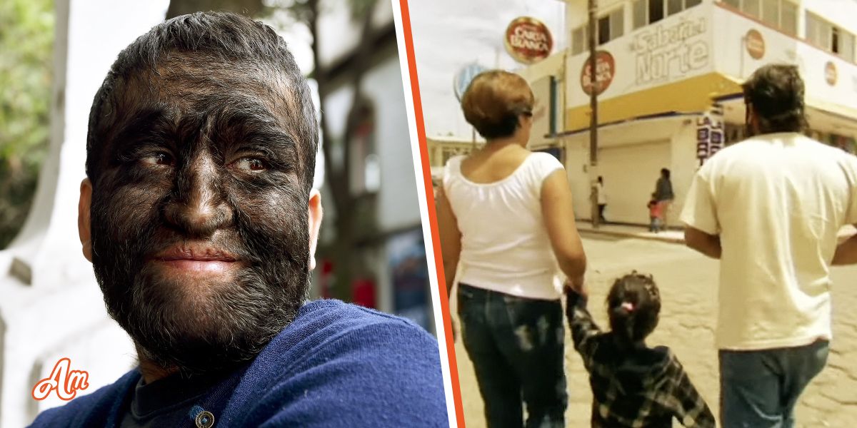 ‘The Wolf Man’ Hid from People Due to His Looks & Later Welcomed ...