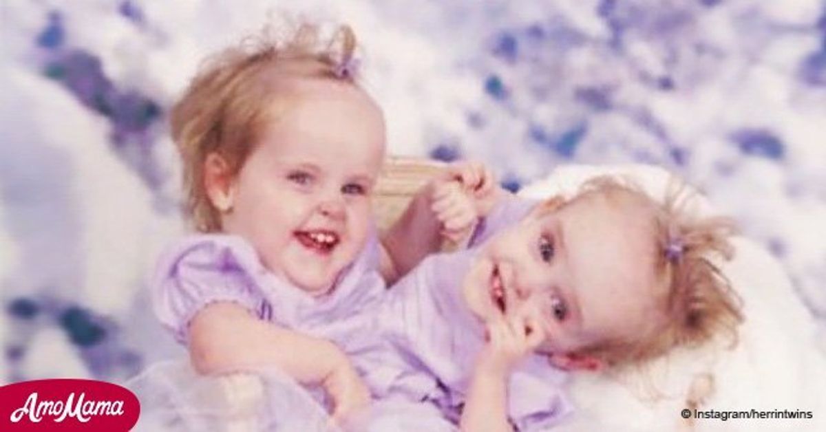 Conjoined twins became famous in 2002. Now they live healthy lives and ...