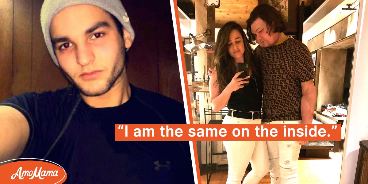 Man, 21, Gets New Face from Dead Man, 48, after Face Transplant Surgery ...