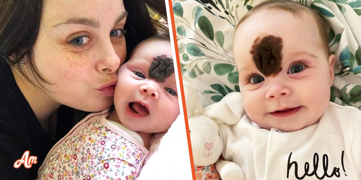 Parents Hid Baby's Face to Shield Her from Stares — Now, at 2, She ...