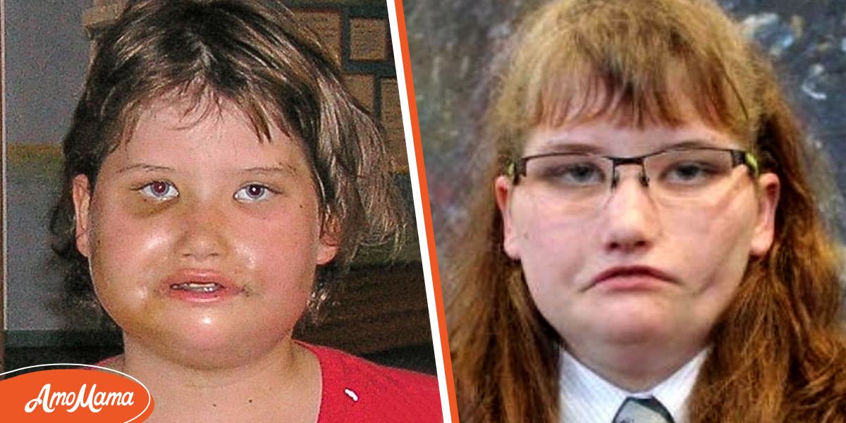 ‘Girl Who Can’t Smile’ Was an Outcast Due to Relentless Bullying — At ...