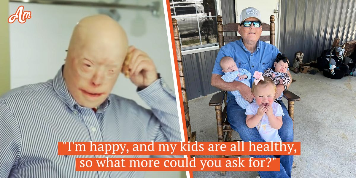 Fireman Got Face Destroyed Saving Lives – 22 Years Later He Has New ...