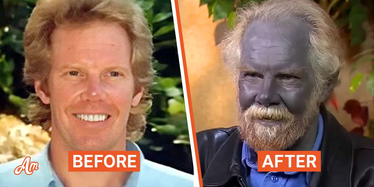 Real-Life ‘Papa Smurf’: Man Turned Blue after Being Born Fair-Skinned ...