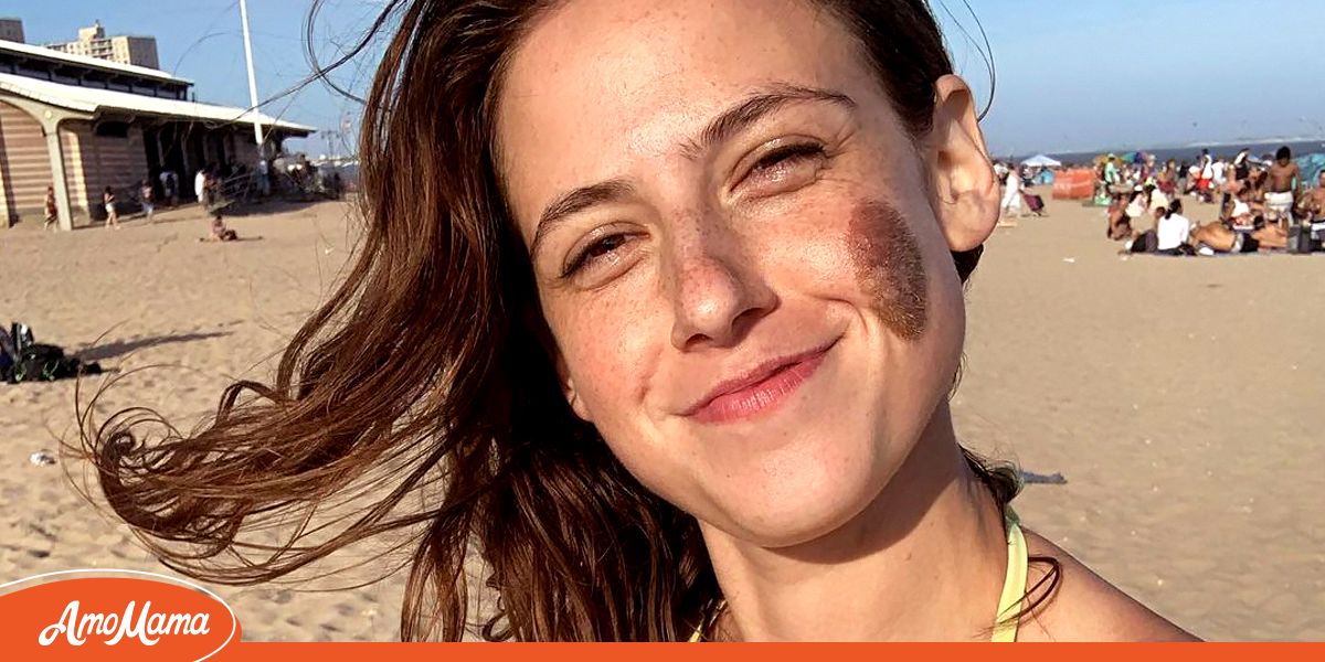 Chloe Radcliffe's Birthmark: The Comedian Is Not Afraid to Joke about ...