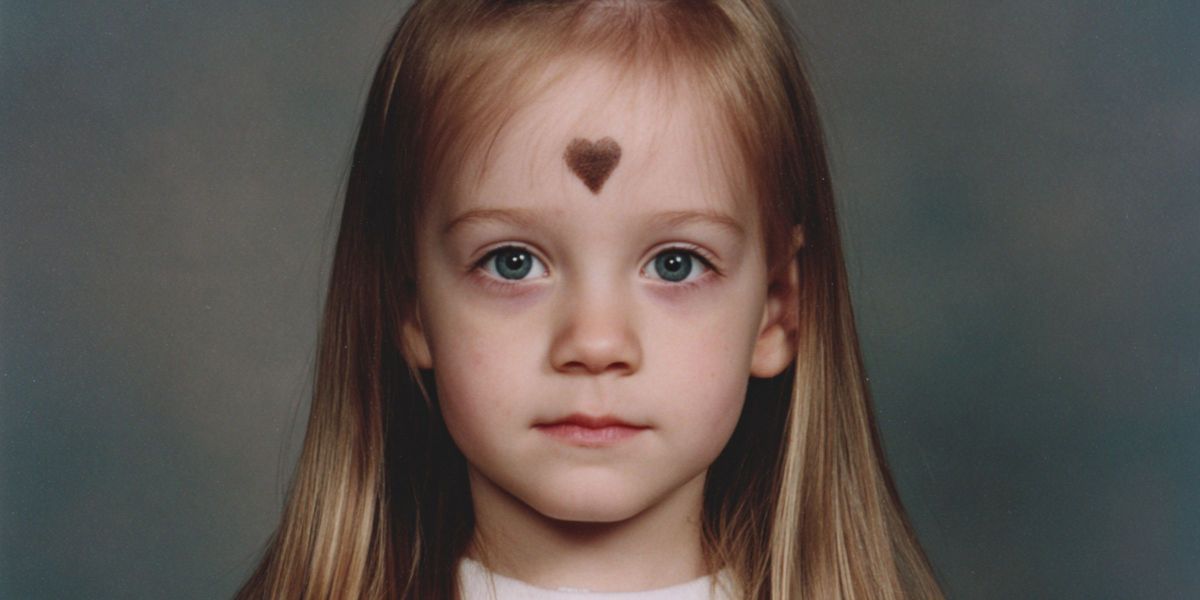 I'd Been Ashamed of the Birthmark on My Forehead Since Childhood – 25 ...
