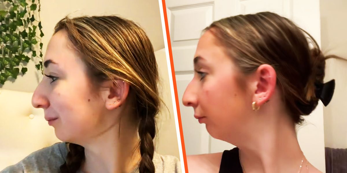 'OMG': This Girl Undergoes Jaw Surgery and Amazed the Internet With ...