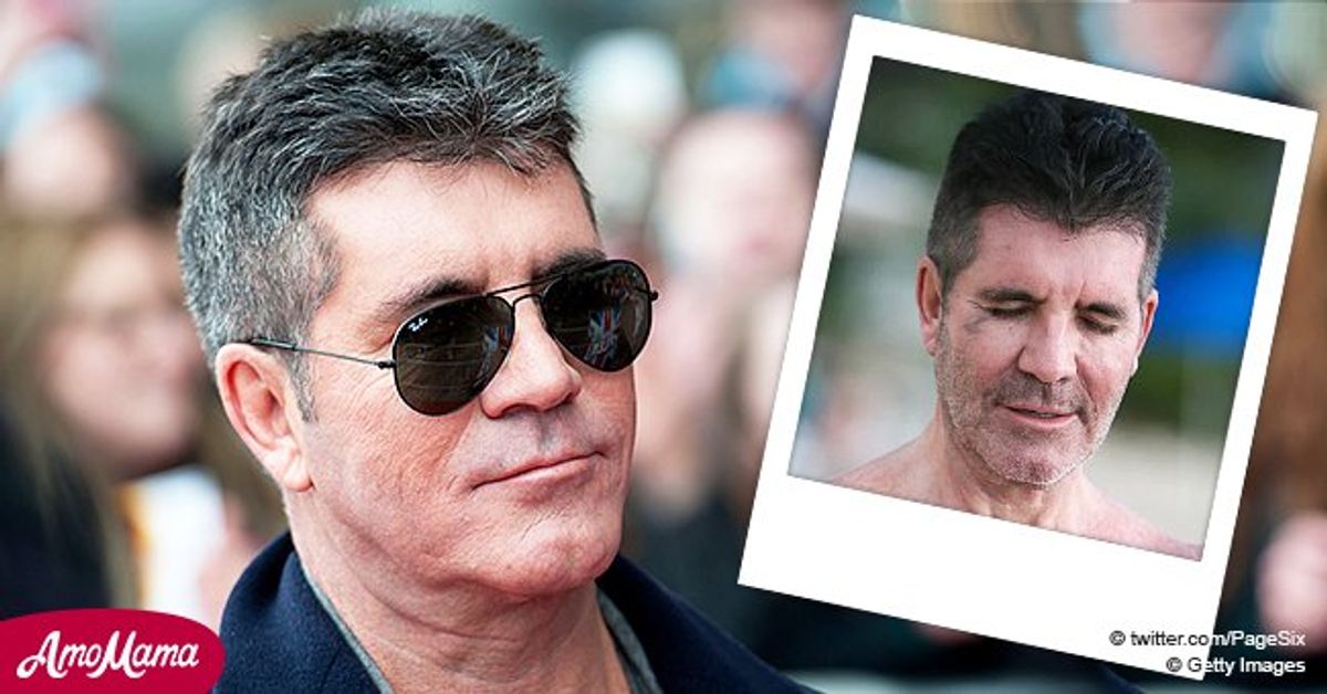 Simon Cowell Reveals Fading Black Eye While Flaunting His Trim Physique ...