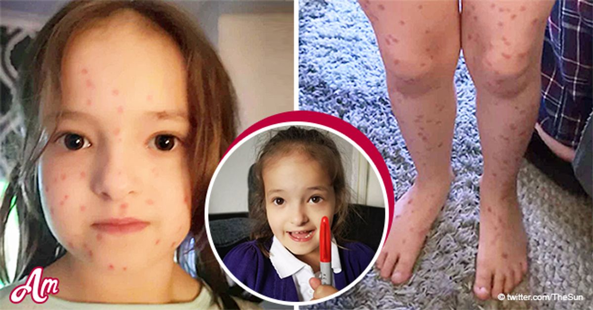 6-Year-Old Marks Herself in Red Blotches for 4 Days after Noticing Sick ...