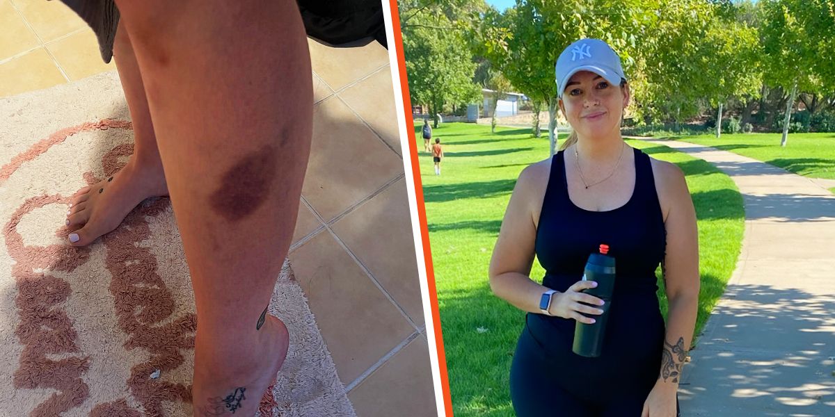 The Woman Thought She Just Had Ordinary Bruises – Years Later, It ...