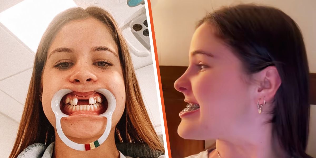 This Girl Spent 6 Years Fixing Her Jaw & After the Final Surgery, She ...