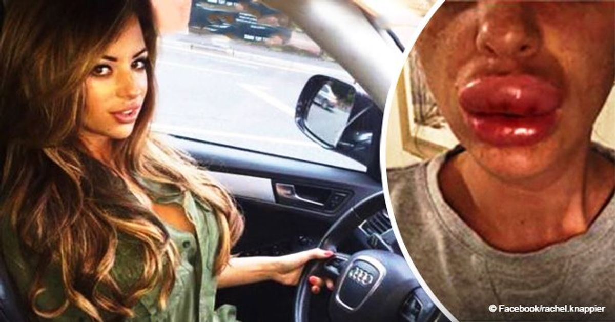 Woman almost lost her lip after fillers at Botox party caused them to ...