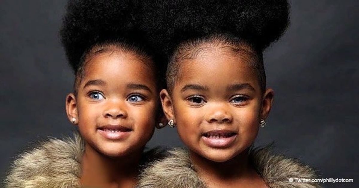 Twin girls who became famous because of their unique eye color are all ...