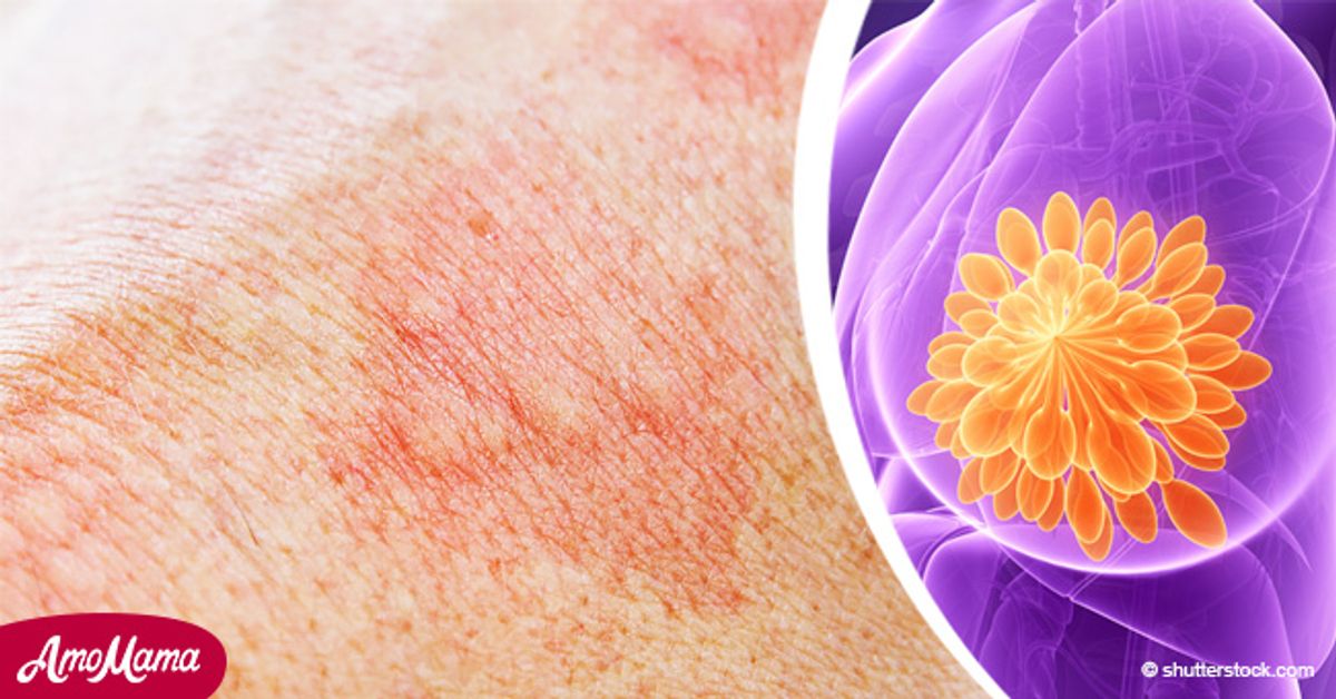 8 Symptoms of Breast Cancer That May Occur without a Noticeable Lump in ...